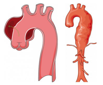 Pathologies cardiaques – CCVT d'OC